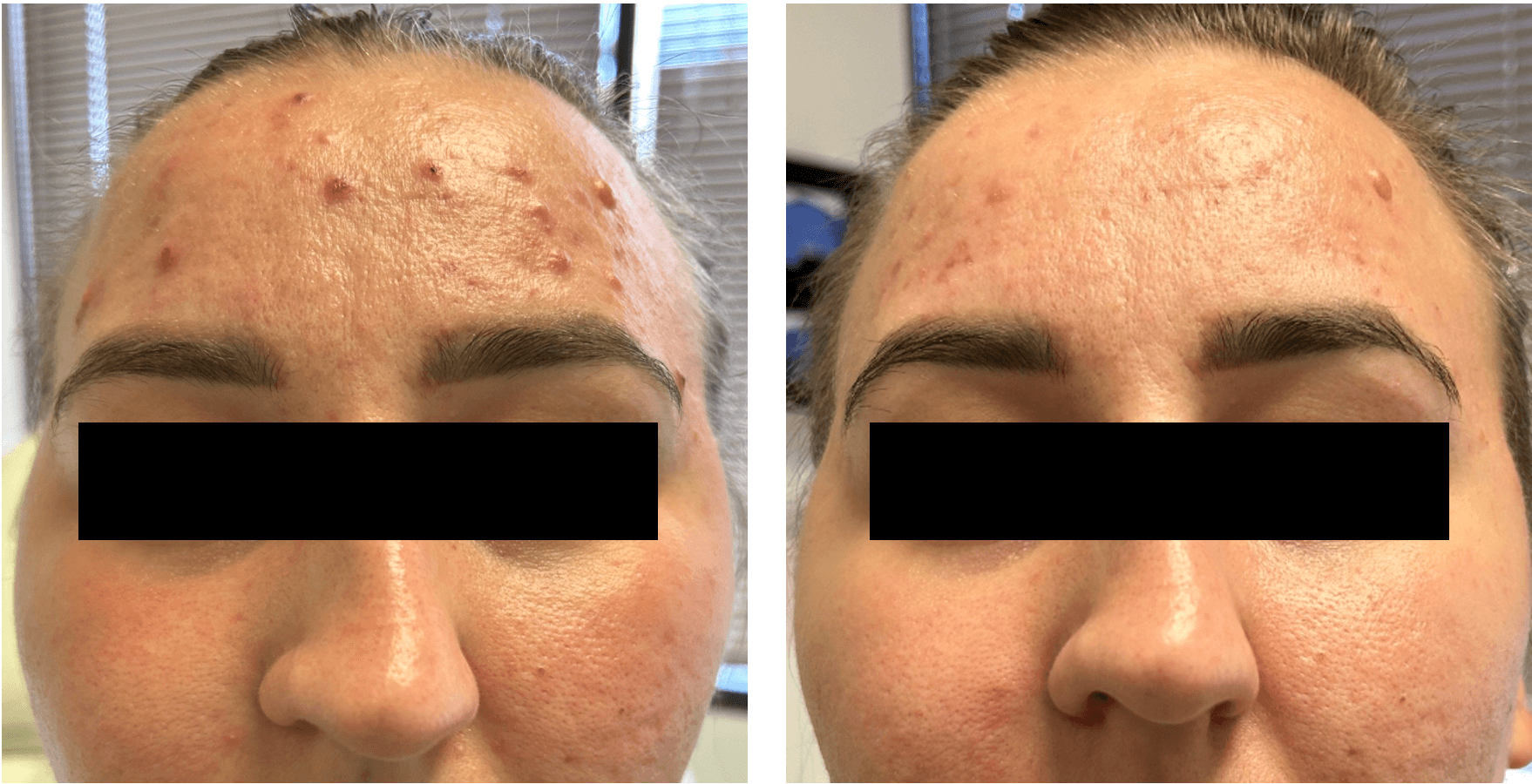 Understanding the Gut-Skin Connection: How Gut Health Affects Acne-Pro – Codex Labs Corp