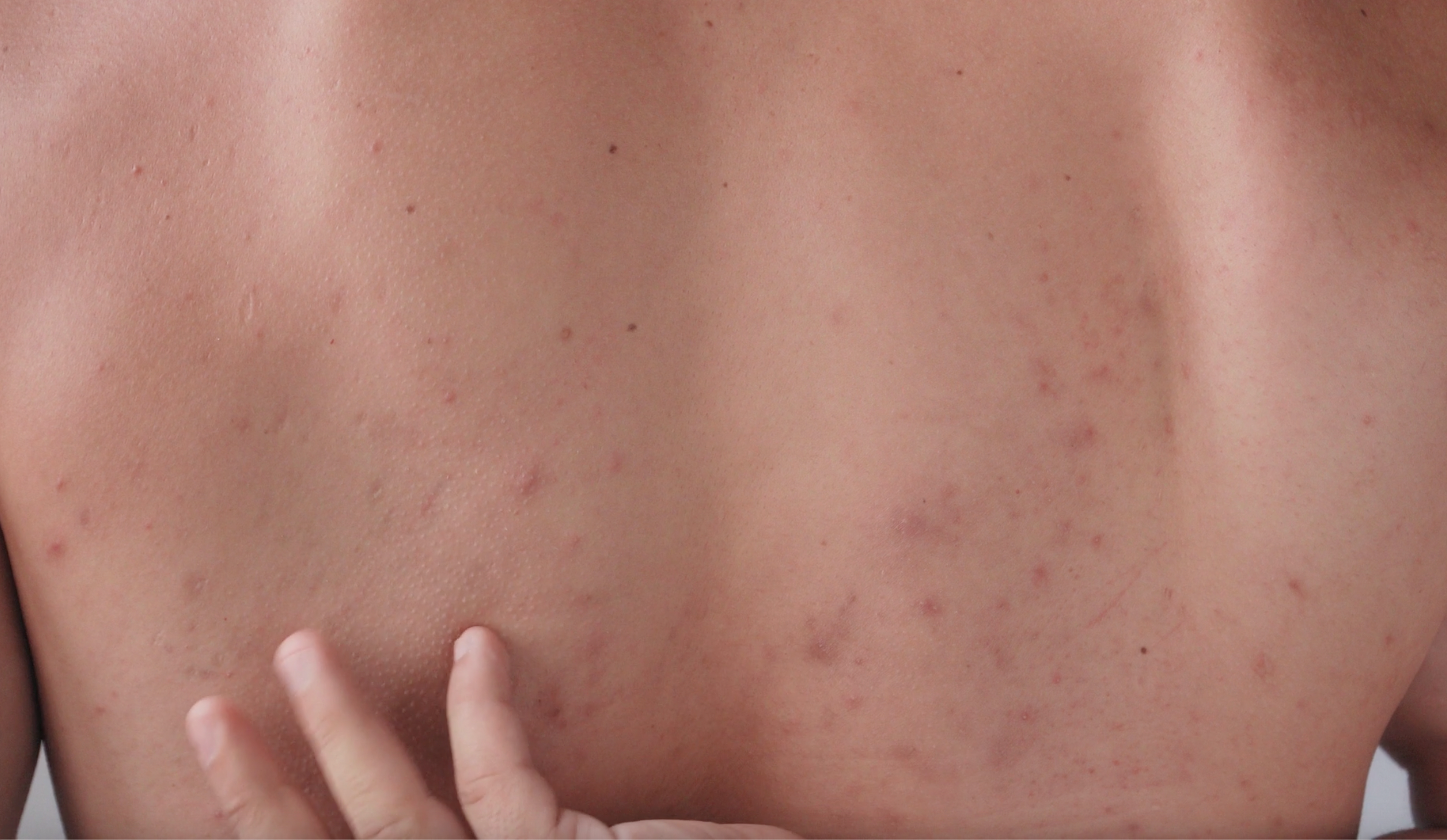 Clear Your Skin: Effective Bacne Treatment Tips – Codex Labs Corp