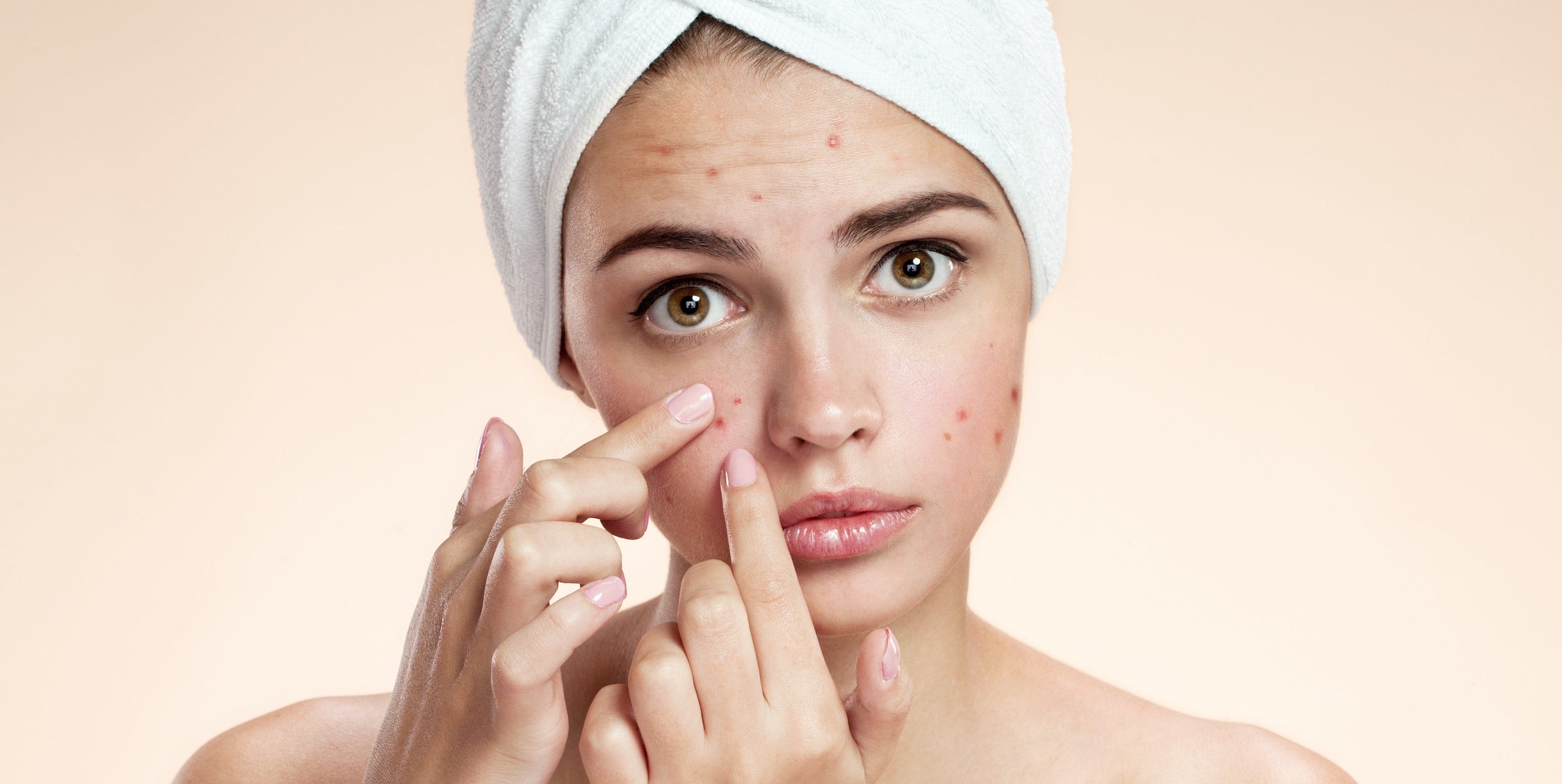 5 Tips For Managing PCOS Induced Hormonal Acne – Codex Labs Corp